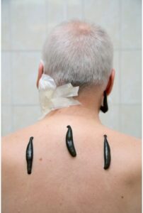 Leech Therapy in Ayurveda | Natural Healing at Navyam Ayurveda